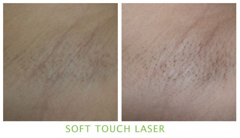 Soft Touch Laser – PureAndBright